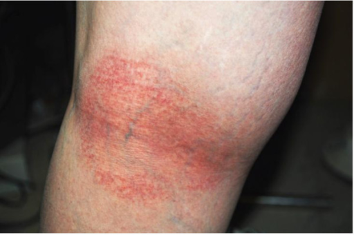 Photograph Of The Posterior Knee Of Case 1 The Figure Shows The Area Two Weeks After The